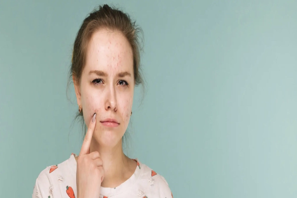 Banishing Acne: A Teen's Guide to Clearer Skin – Manuka Biotic