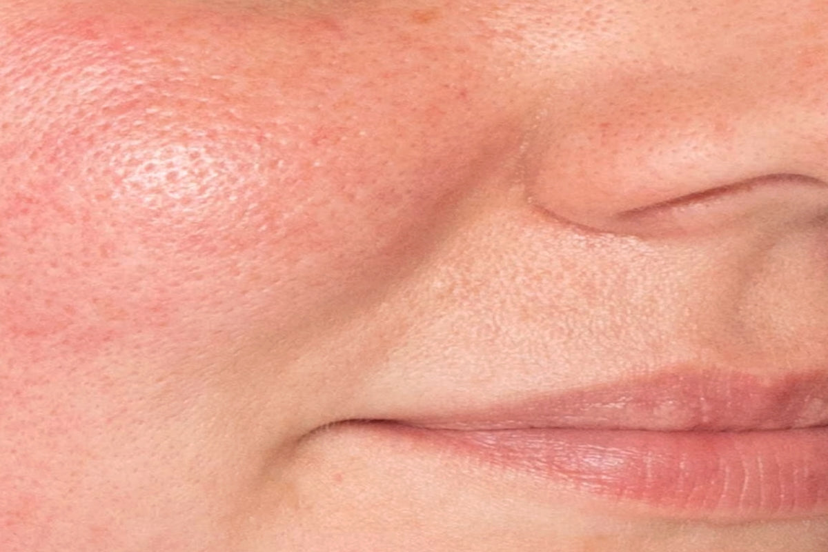 Rosacea and Sensitive Skin: How Gentle Skincare and Mānuka Oil Support ...